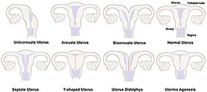 The impact of congenital uterine abnormalities on pregnancy and ...